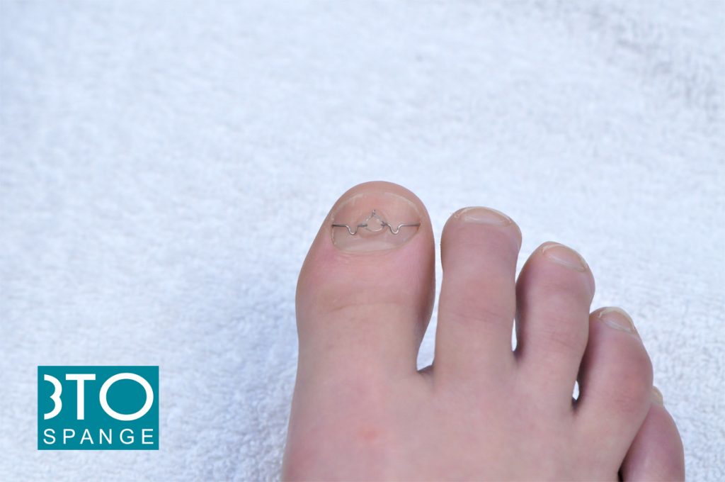 Spangentherapie Nagelkorrekturspange eingewachsener Nagel